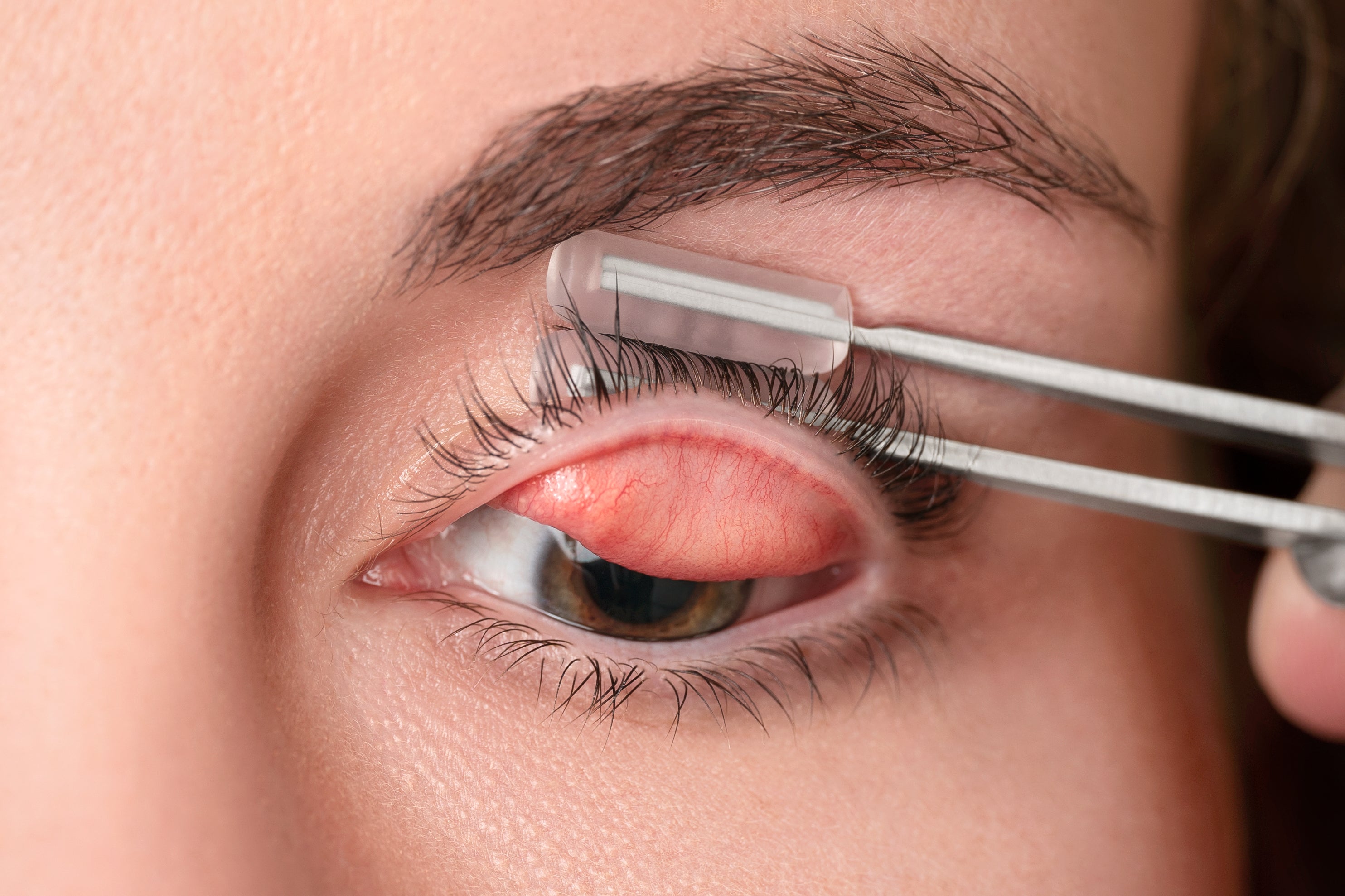 Meivertor eyelid eversion tool UPPER and lower eyelid eversion